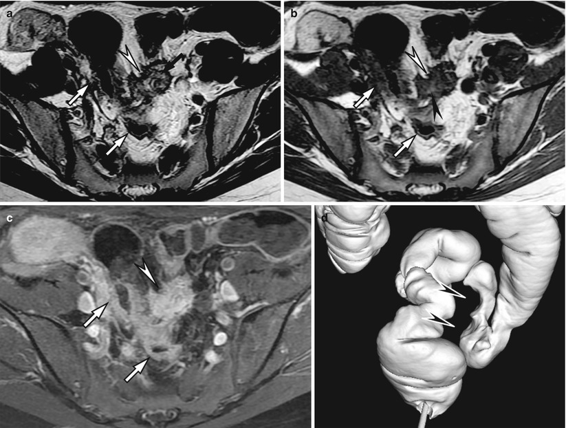 Inflammatory and Infectious Disease of the Colon | Radiology Key