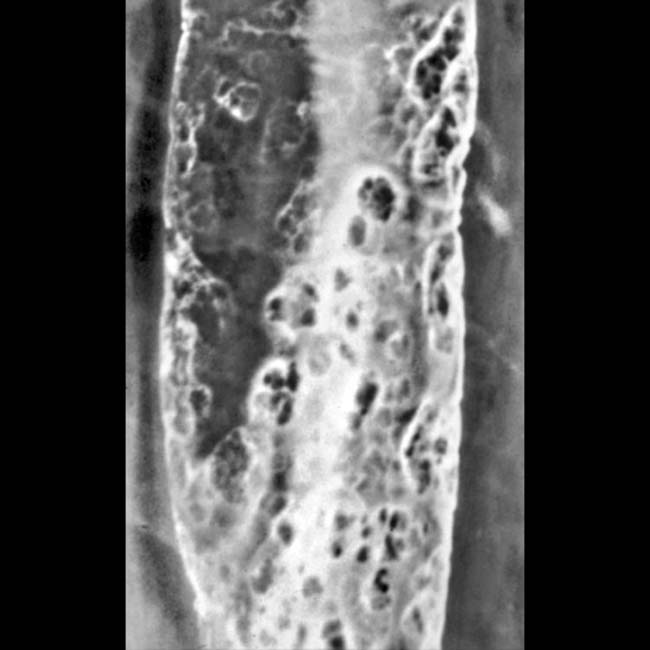 Viral Esophagitis | Radiology Key