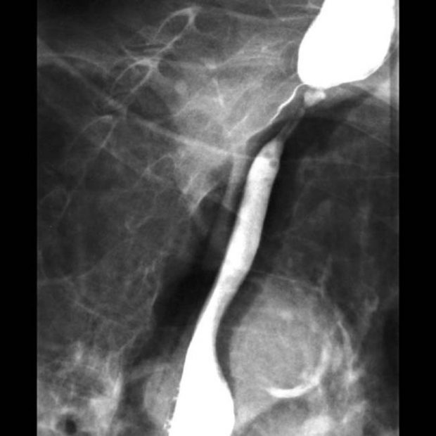Drug-Induced Esophagitis | Radiology Key