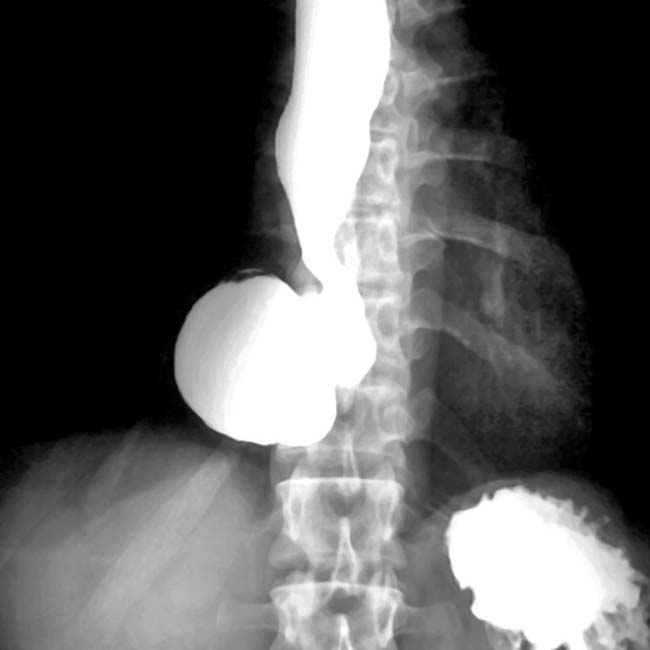 Esophageal Achalasia | Radiology Key