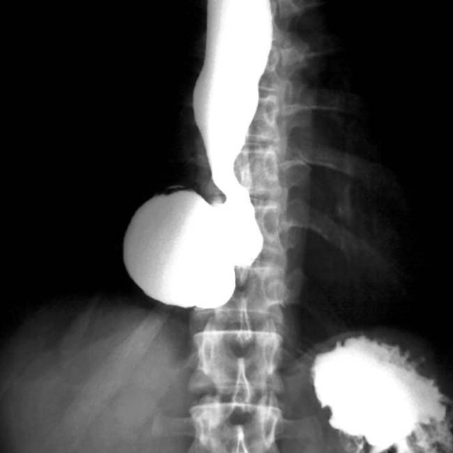 Pulsion Diverticulum | Radiology Key