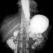 Esophageal Scleroderma | Radiology Key