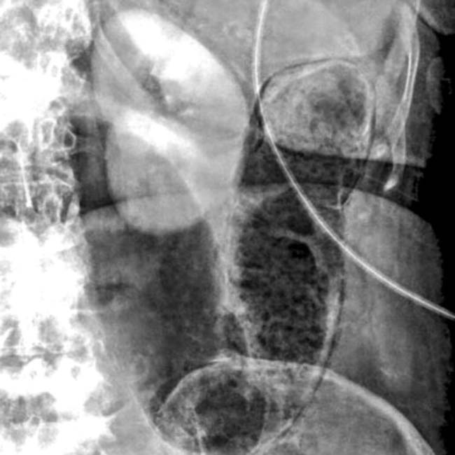 Pneumatosis of the Intestine | Radiology Key