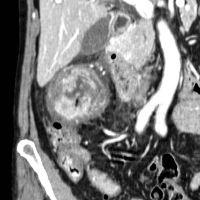 Colonic Metastases and Lymphoma | Radiology Key