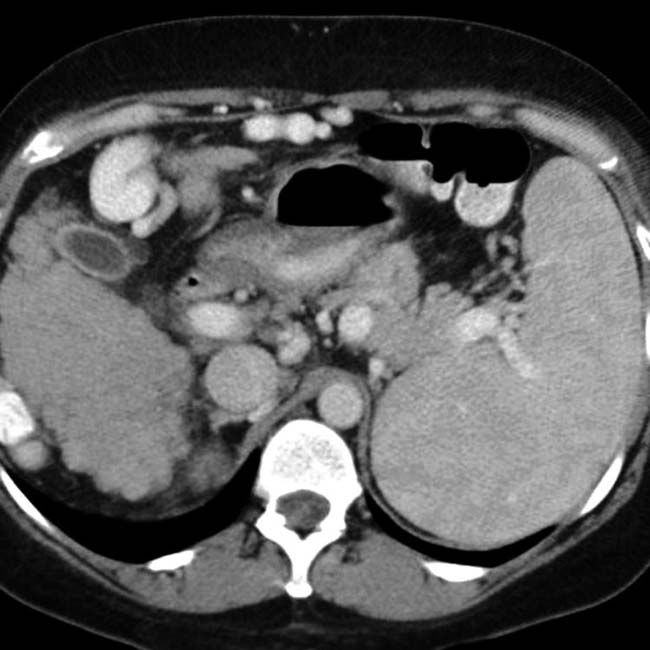 Splenomegaly and Hypersplenism | Radiology Key