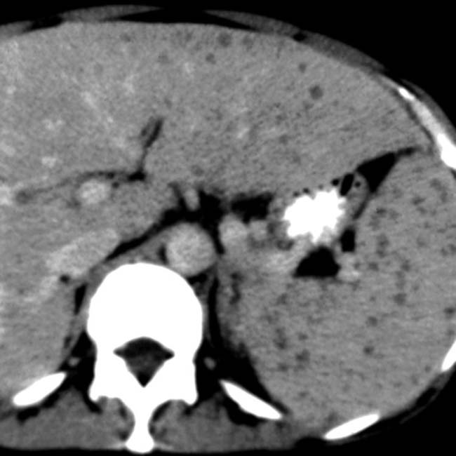 Hepatic TB and Fungal Infections | Radiology Key