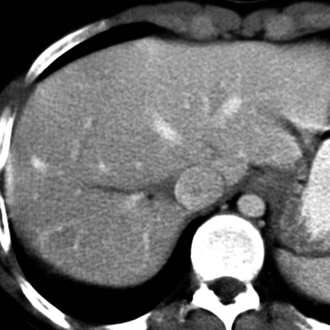 Hepatic Trauma | Radiology Key
