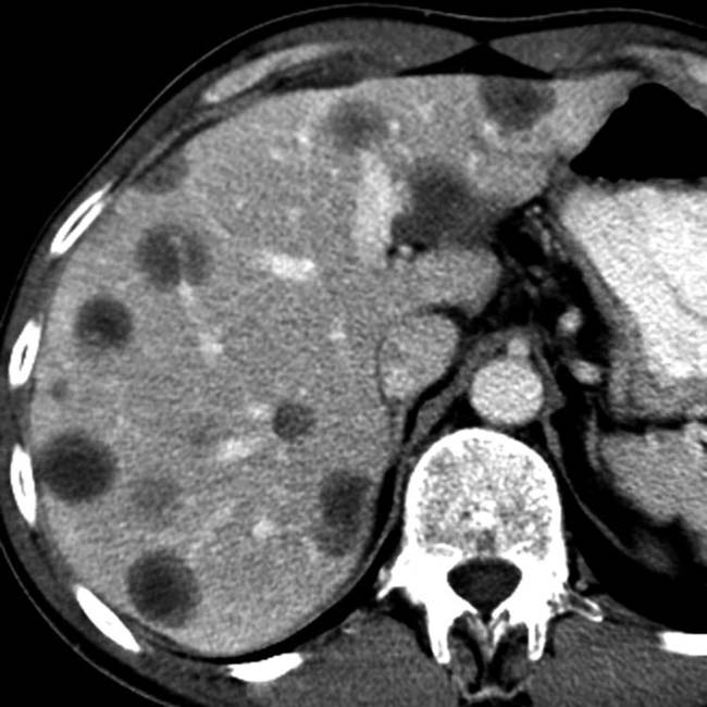 Epithelioid Hemangioendothelioma | Radiology Key