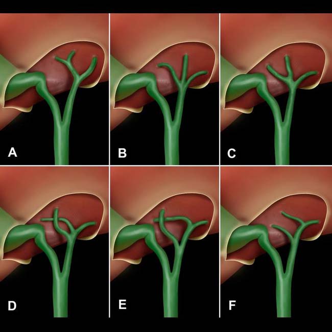 Biliary Normal Variants And Artifacts Radiology Key
