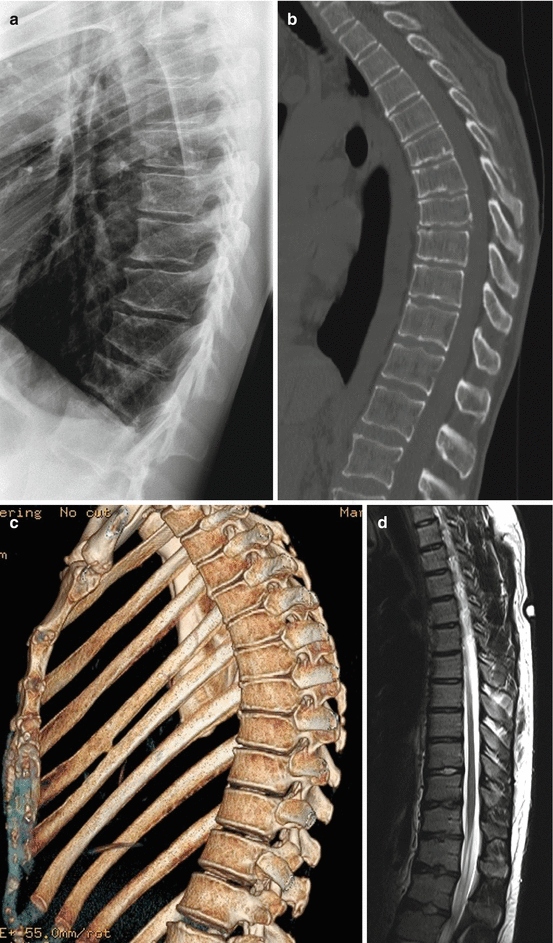 Radiologic Imaging of Spine Injuries | Radiology Key