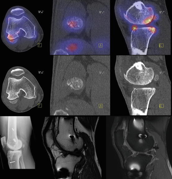 Nuclear Medicine Imaging of Knee Injuries | Radiology Key