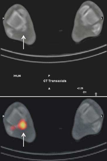 Nuclear Medicine Imaging of Foot Injuries | Radiology Key
