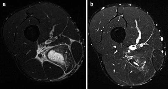 The Role of Radiologic Imaging Techniques in Pathophysiology of Sports ...
