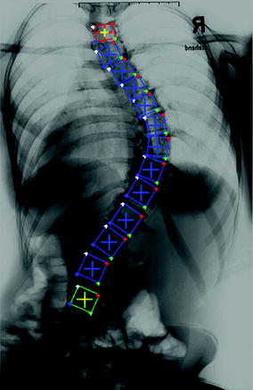 Model-Based Vertebra Identification from X-Ray Image(s) | Radiology Key