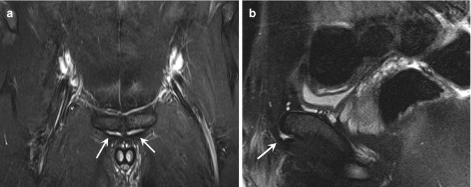 Imaging of Football (Soccer) Injuries | Radiology Key