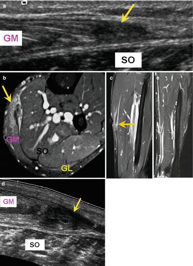 Imaging of Rugby Injuries | Radiology Key