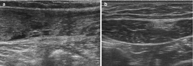 Imaging of Tennis Injuries | Radiology Key