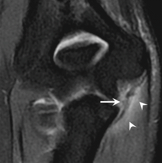 Imaging of Track and Field Injuries | Radiology Key