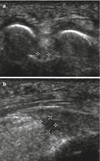 Imaging of Rodeo and Equestrian Injuries | Radiology Key