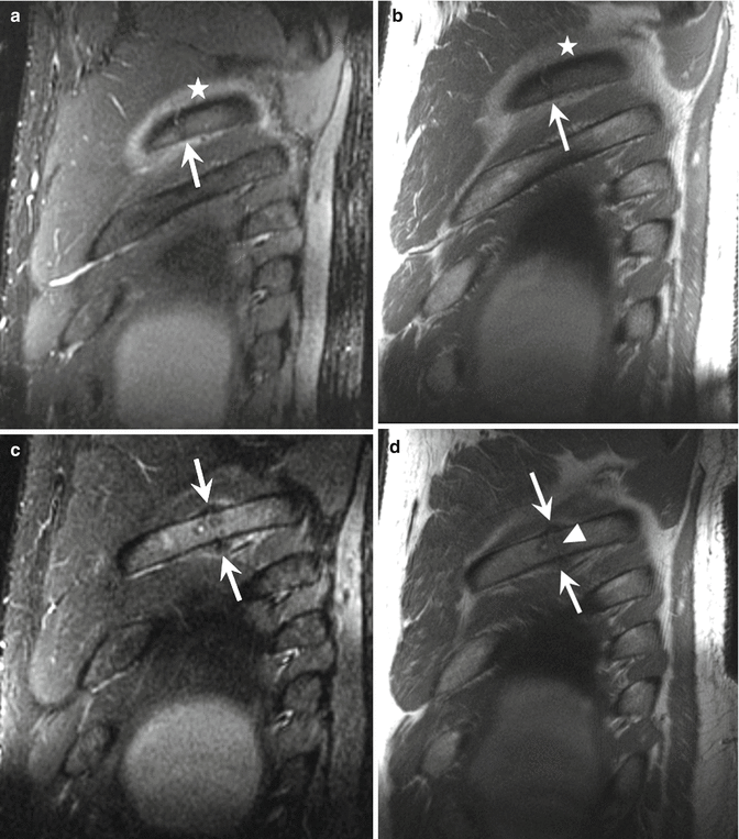 The Role of MRI in Sports Medicine | Radiology Key