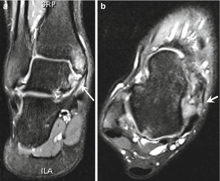 Imaging of Handball Injuries | Radiology Key
