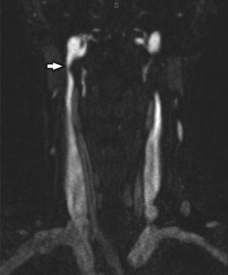 Jugular Vein Thrombosis | Radiology Key