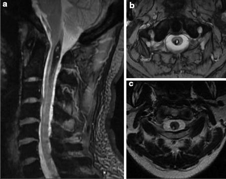 Spinal Vascular Malformations and Treatment | Radiology Key