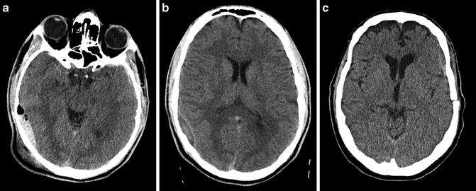 Hemorrhagic Stroke | Radiology Key