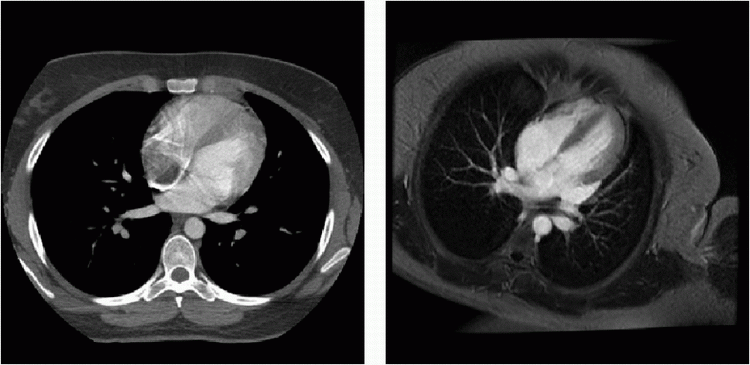 Cardiac Masses | Radiology Key