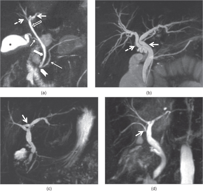 The cross-sectional anatomy of the liver and normal variations ...