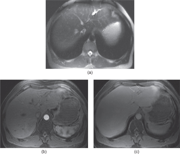Infectious diseases of the liver | Radiology Key