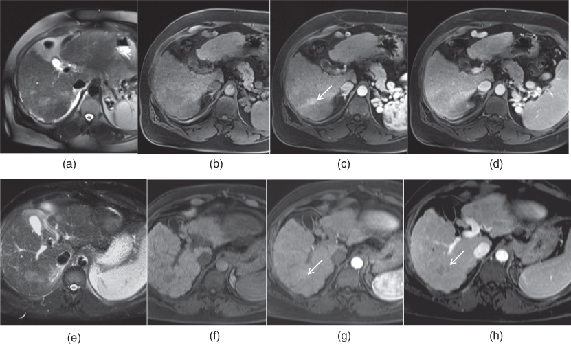 Chronic hepatitis and liver cirrhosis | Radiology Key