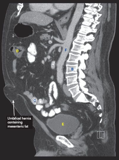 Hernias | Radiology Key