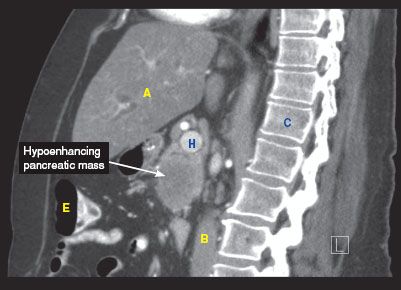 Pancreas | Radiology Key
