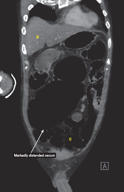 Large Bowel | Radiology Key