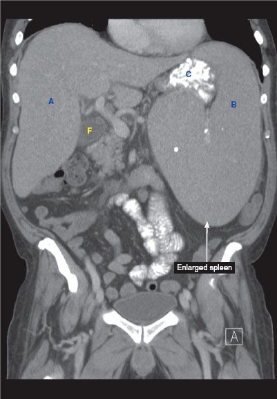 Spleen | Radiology Key
