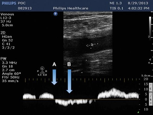Normal Blood Flow in Arteries and Veins | Radiology Key