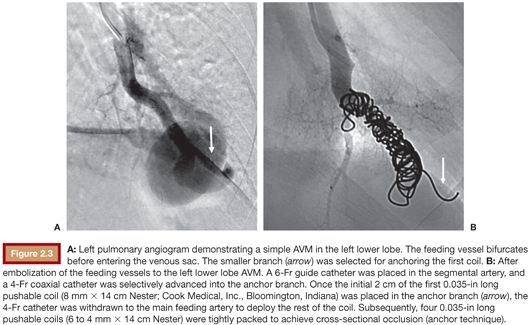 Pushable Coils | Radiology Key