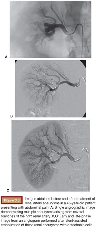 Detachable Coils | Radiology Key