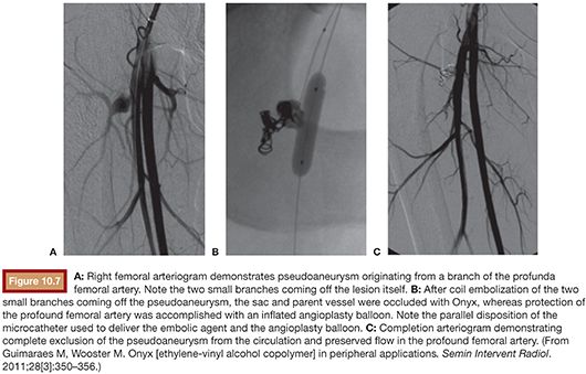 EVOH/DMSO in Peripheral Application | Radiology Key