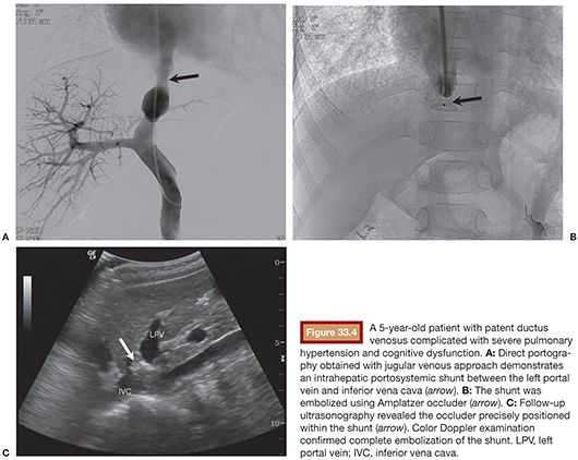 Transcatheter Arterial Embolization of Benign Liver Disease | Radiology Key