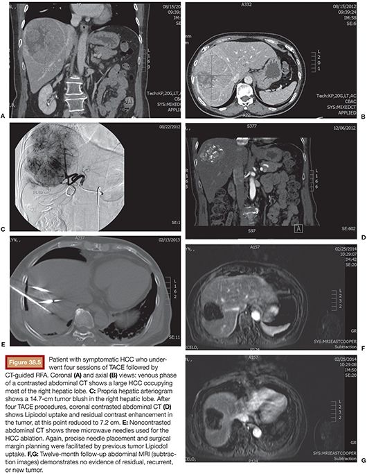 Combined Therapies | Radiology Key