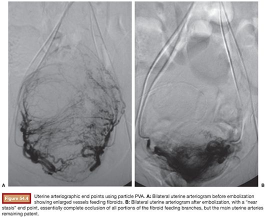 Uterine Fibroids | Radiology Key