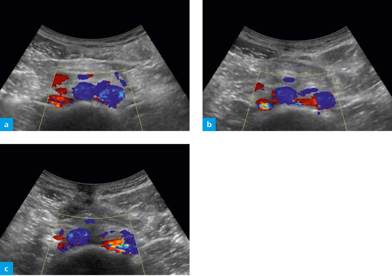 bifurcation | Radiology Key