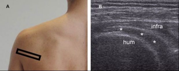 Sternoclavicular Joint | Radiology Key