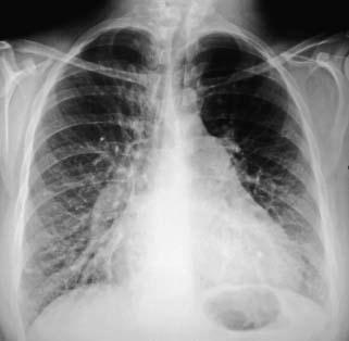 LINES, AND CATHETERS | Radiology Key