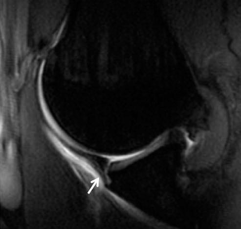 MRI of Glenohumeral Instability | Radiology Key