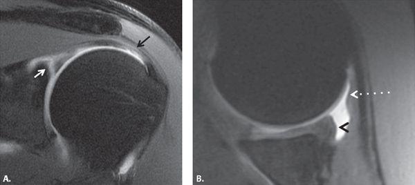 Long Bicipital Tendon Including Superior Labral Anterior–Posterior ...