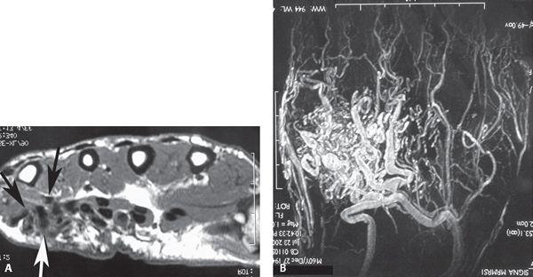 Miscellaneous Disorders of the Finger | Radiology Key