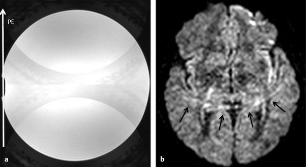 Physics of Diffusion Weighted and Diffusion Tensor Imaging | Radiology Key